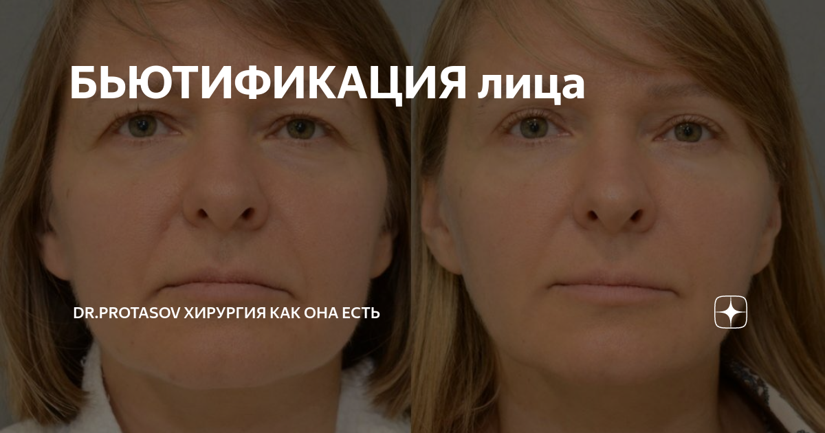 БЬЮТИФИКАЦИЯ лица | Dr.Protasov хирургия как она есть | Дзен