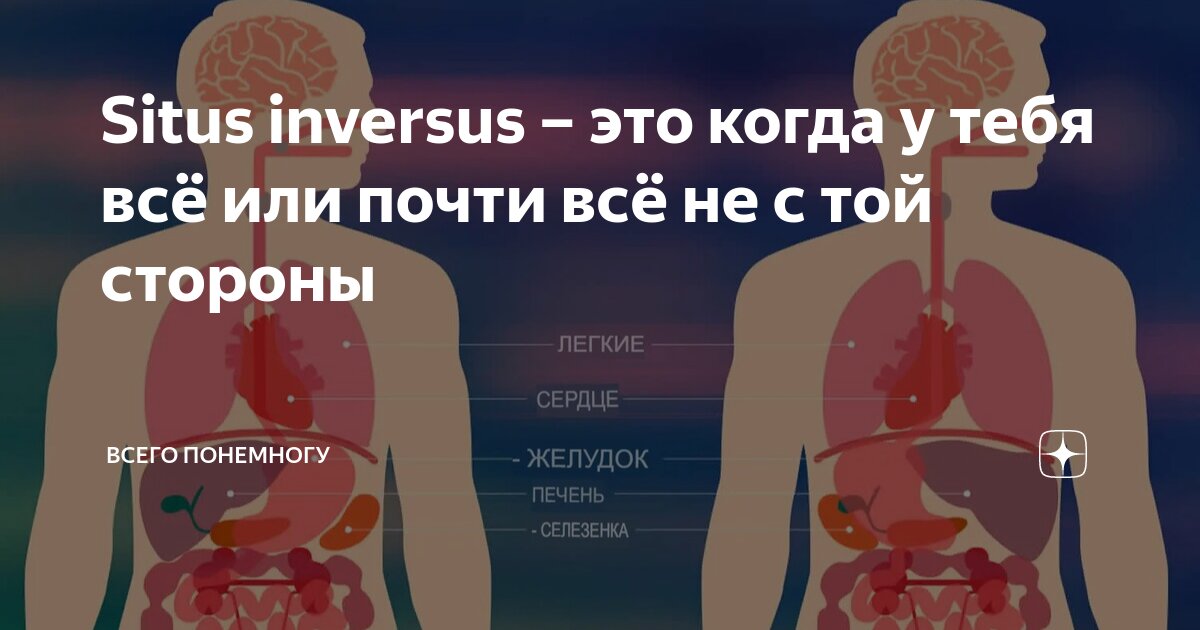 Situs inversus – это когда у тебя всё или почти всё не с той стороны ...