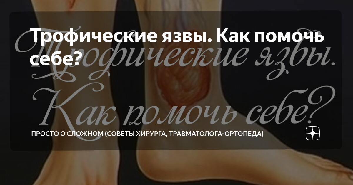 Трофические язвы. Как помочь себе? | Просто о сложном (советы хирурга ...