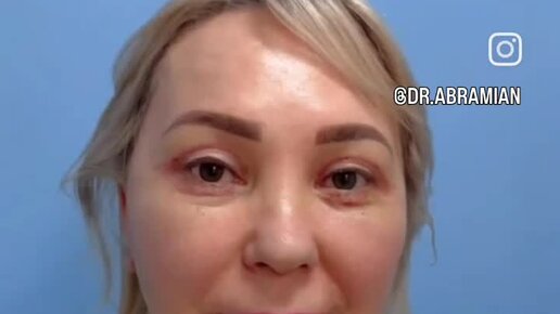Dr.Abramian 😷 пластический хирург | Омоложение лица | Дзен