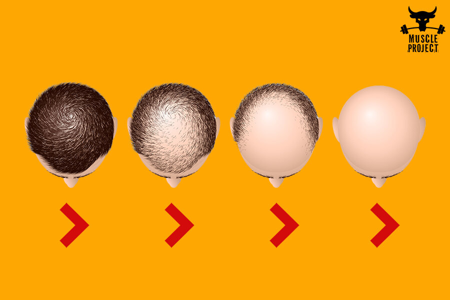 Почему многие мужчины с годами начинают лысеть и какие методы "средства ...