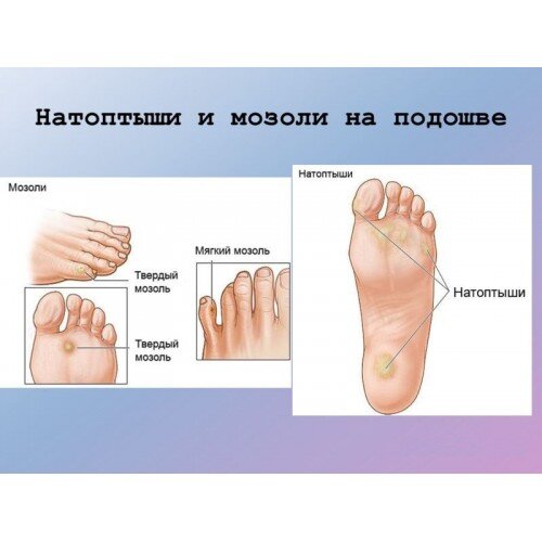 Почему болят стопы? О чем говорят мозоли на стопах? | Студия Активного ...