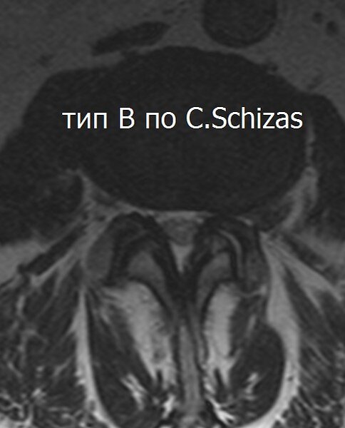Классификация стенозов по C. Schizas | D2D Expert | Дзен