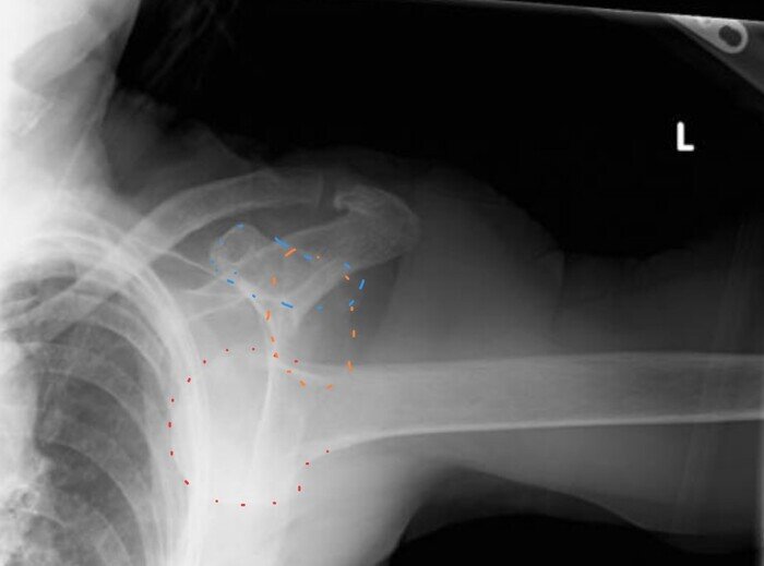 Случай из рентгенологической практики: luxatio erecta | Пикабу | Дзен