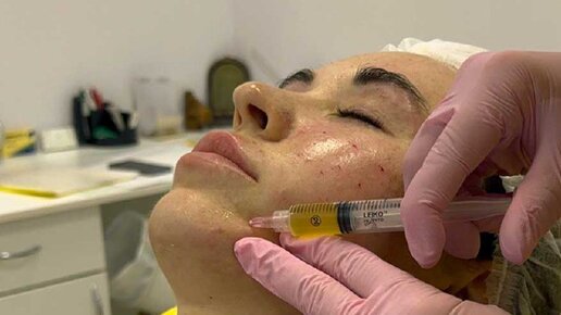 Врач-косметолог Татьяна. Ботокс/ Нити/ Аппараты | Лечение кожи с помощью плазмы 😱 Прыщи, сухость ...