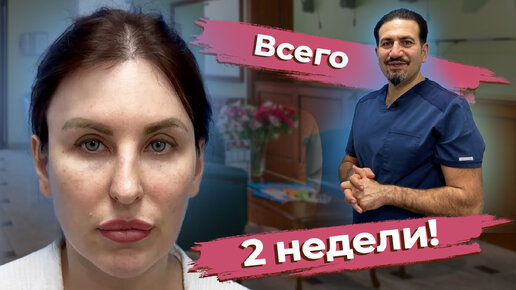 Подтяжка лица и высочный лифтинг | Dr.Abramian 😷 пластический хирург | Дзен