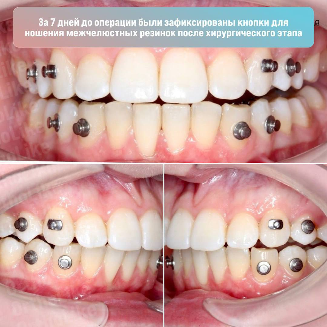 Третье ортодонтическое лечение у пациента с дистальным прикусом: кейс врача-ортодонта OrthoLike ...