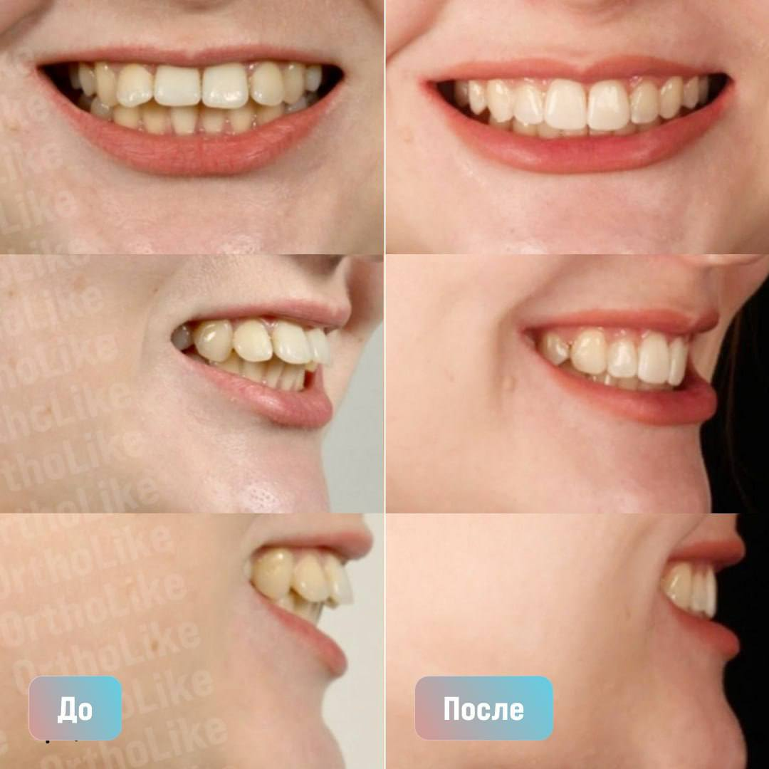 Третье ортодонтическое лечение у пациента с дистальным прикусом: кейс врача-ортодонта OrthoLike ...