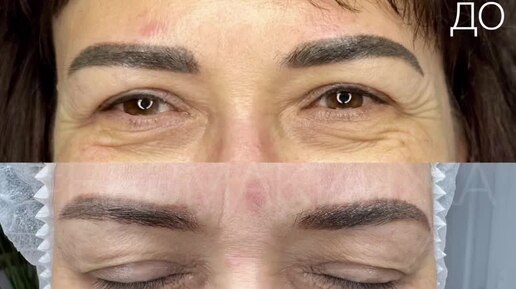 ЖИВАЯ КОЖА | Фенева Татьяна | УДАЛЕНИЕ ТАТУАЖА БРОВЕЙ | Запись на процедуру в Москве по номеру ...