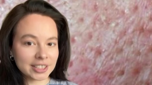 NATALIA_BBOS I уход, естественная красота, самомассаж | 1 средство для 4 проблем #уход #акне # ...