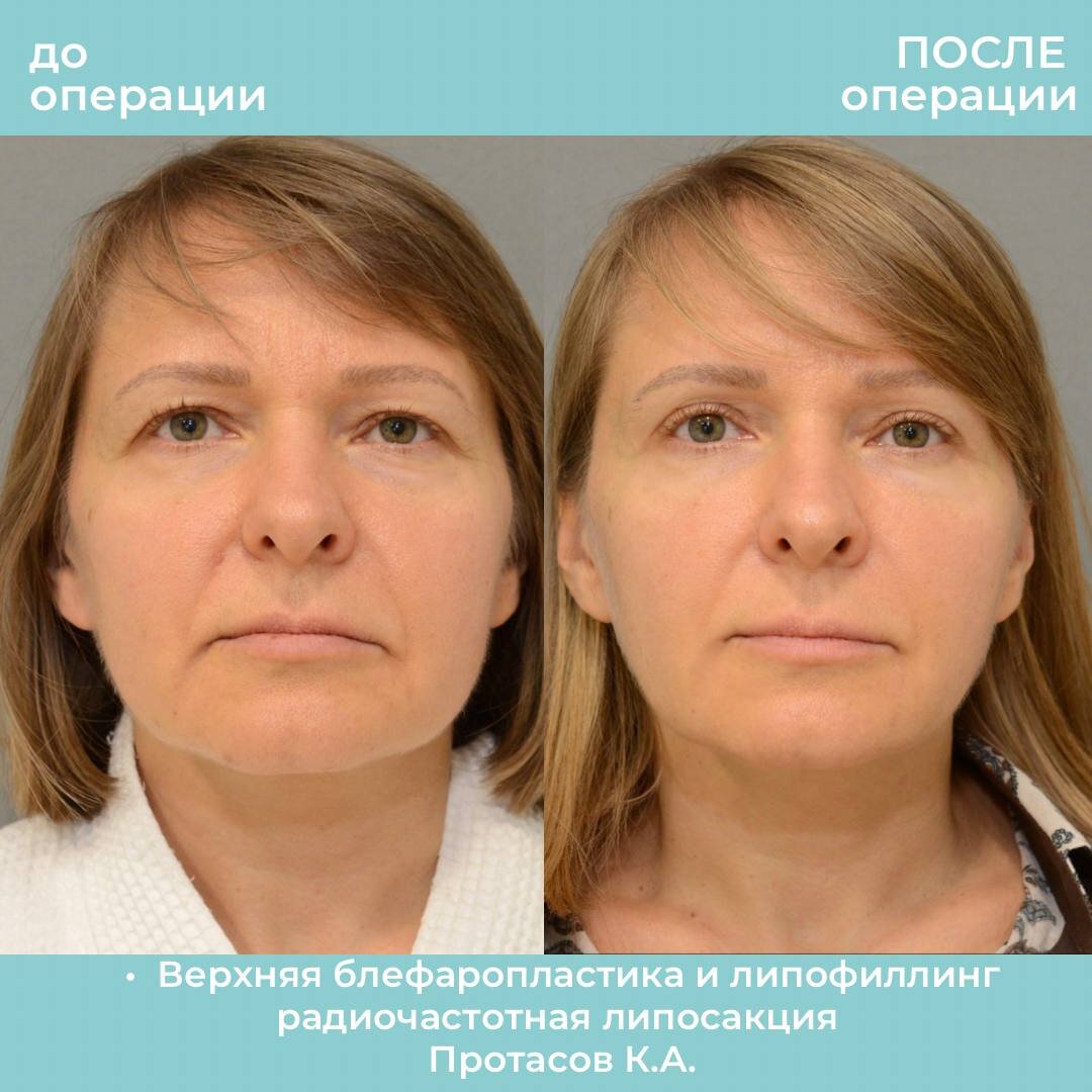 БЬЮТИФИКАЦИЯ лица | Dr.Protasov хирургия как она есть | Дзен