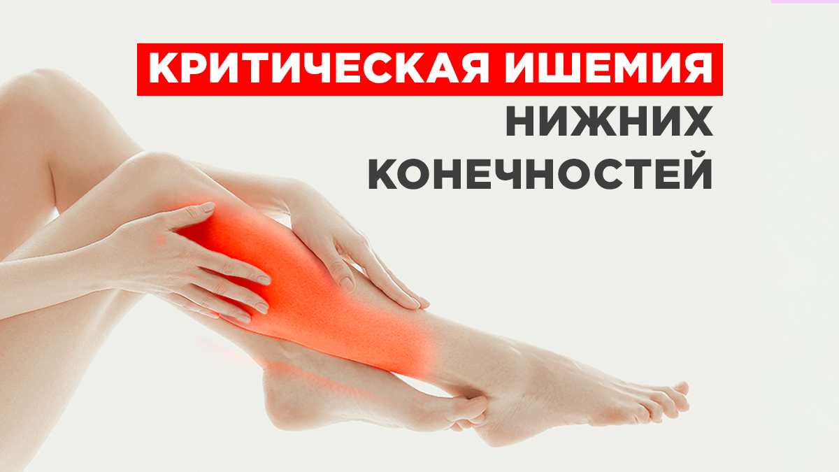 Критическая ишемия нижних конечностей Первый клинический медицинский