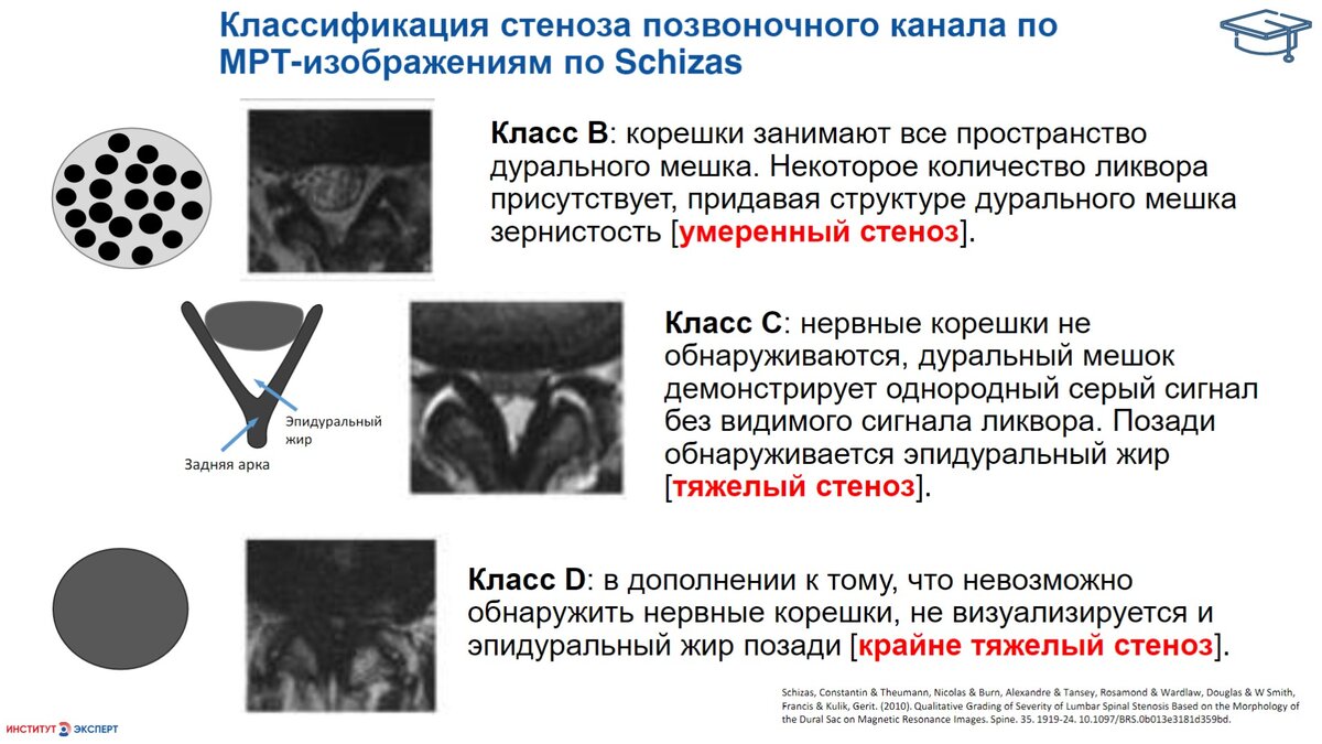 Классификация стенозов по C. Schizas | D2D Expert | Дзен