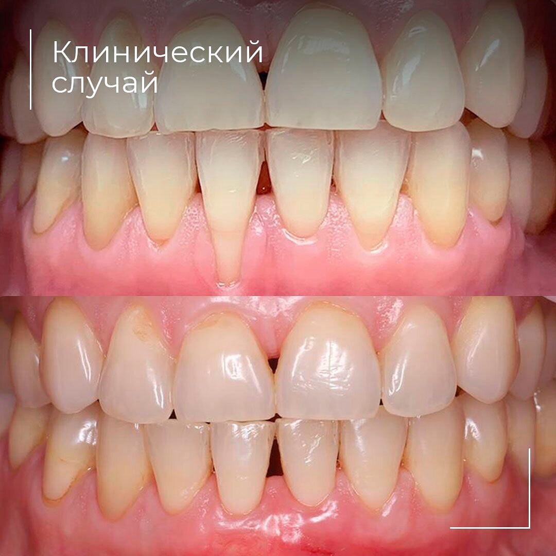 Корни зубов оголились после ортодонтии. Лечим рецессию десны | Георгий ...