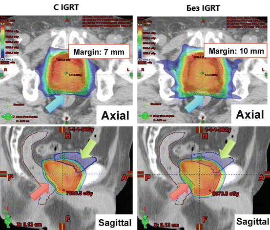 Лучевая терапия рака простаты: линейный ускоритель, томотерапия или ...