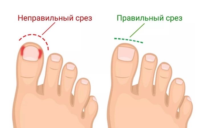 Как правильно подстригать ногти на ногах Татьяна Королёва Дзен